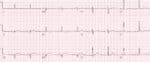 Subtle Inferior MI | ECG cases | EM cases