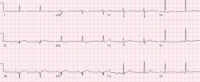 Subtle Inferior MI | ECG cases | EM cases