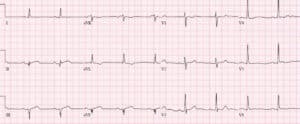 Subtle Inferior MI | ECG cases | EM cases