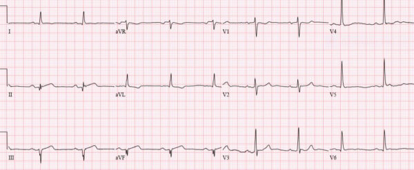 Subtle Inferior MI | ECG cases | EM cases