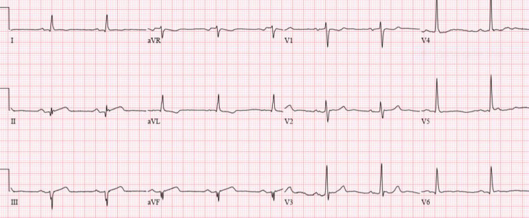 Subtle Inferior MI | ECG cases | EM cases