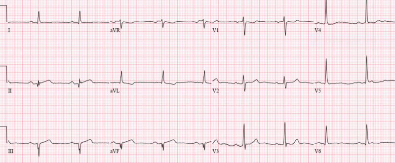 Subtle Inferior MI | ECG cases | EM cases