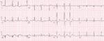 Subtle Inferior MI | ECG cases | EM cases