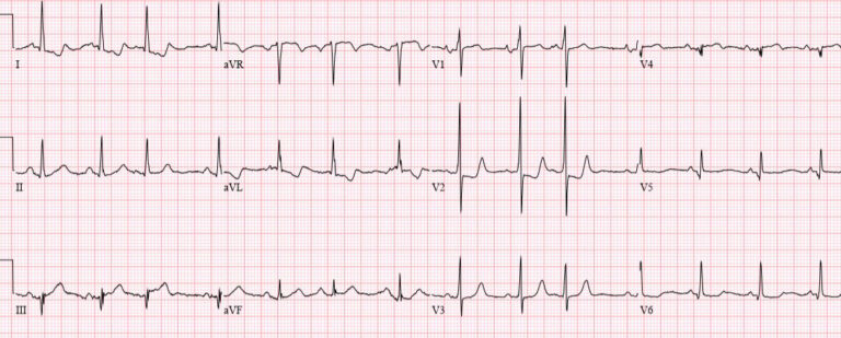 Subtle Inferior MI | ECG cases | EM cases