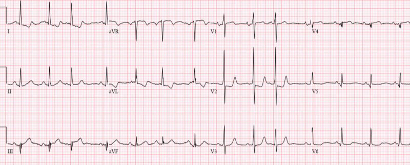 Subtle Inferior MI | ECG cases | EM cases