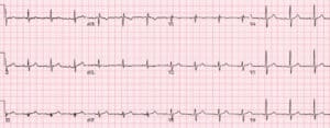 Subtle Inferior MI | ECG cases | EM cases