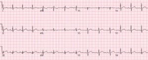 Subtle Inferior MI | ECG cases | EM cases