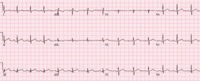 Subtle Inferior MI | ECG cases | EM cases