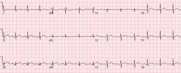 Subtle Inferior MI | ECG cases | EM cases