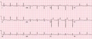 Subtle Inferior MI | ECG cases | EM cases