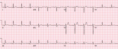Subtle Inferior MI | ECG cases | EM cases