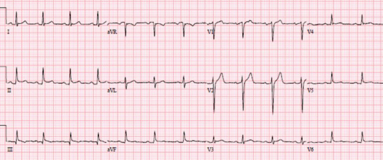 Subtle Inferior MI | ECG cases | EM cases