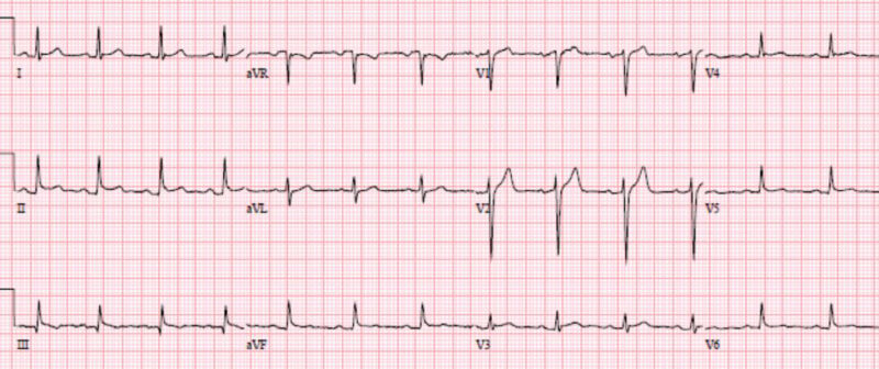 Subtle Inferior MI | ECG cases | EM cases