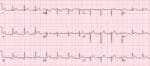 Subtle Inferior MI | ECG cases | EM cases