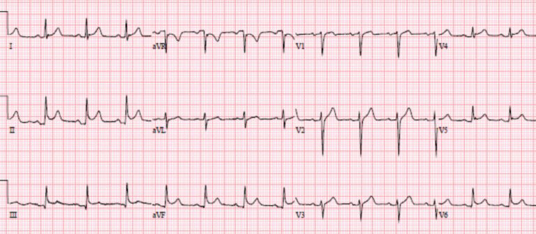 Subtle Inferior MI | ECG cases | EM cases