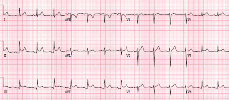 Subtle Inferior MI | ECG cases | EM cases