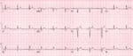 Subtle Inferior MI | ECG cases | EM cases