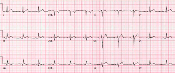 Subtle Inferior MI | ECG cases | EM cases