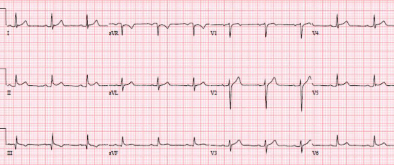Subtle Inferior MI | ECG cases | EM cases