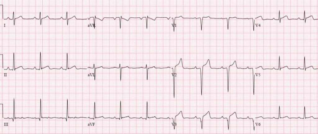 early repolarization or anterior STEMI | ECG cases | EM cases