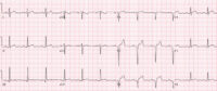 early repolarization or anterior STEMI | ECG cases | EM cases
