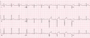 early repolarization or anterior STEMI | ECG cases | EM cases