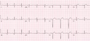early repolarization or anterior STEMI | ECG cases | EM cases