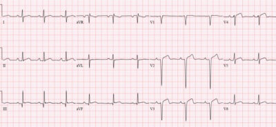 early repolarization or anterior STEMI | ECG cases | EM cases