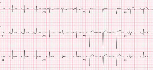 early repolarization or anterior STEMI | ECG cases | EM cases