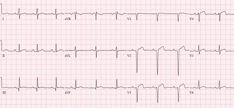 early repolarization or anterior STEMI | ECG cases | EM cases