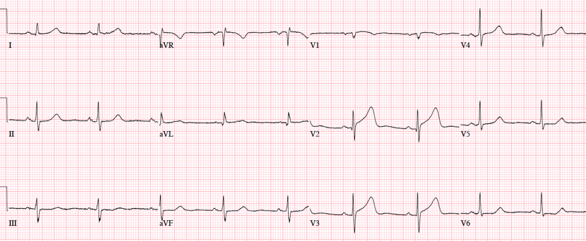 early repolarization or anterior STEMI | ECG cases | EM cases