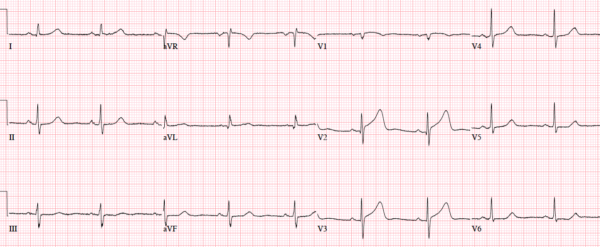 early repolarization or anterior STEMI | ECG cases | EM cases