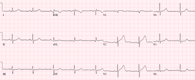 early repolarization or anterior STEMI | ECG cases | EM cases