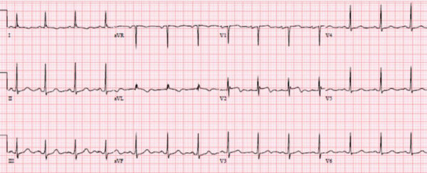 early repolarization or anterior STEMI | ECG cases | EM cases