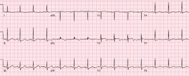 early repolarization or anterior STEMI | ECG cases | EM cases