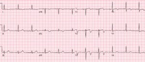 early repolarization or anterior STEMI | ECG cases | EM cases