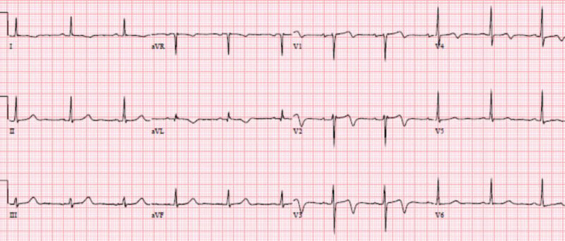 early repolarization or anterior STEMI | ECG cases | EM cases