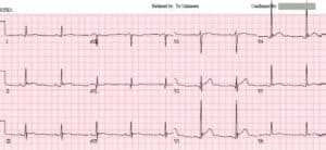 early repolarization or anterior STEMI | ECG cases | EM cases