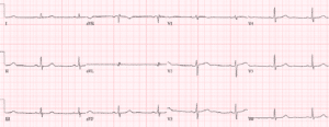 early repolarization or anterior STEMI | ECG cases | EM cases