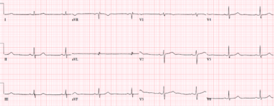 early repolarization or anterior STEMI | ECG cases | EM cases