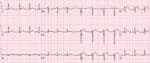 early repolarization or anterior STEMI | ECG cases | EM cases