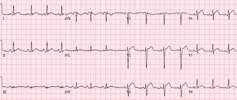 early repolarization or anterior STEMI | ECG cases | EM cases