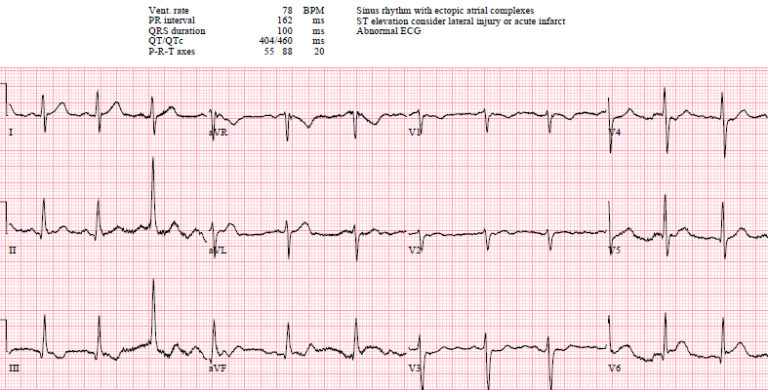 Lateral STEMI or Occlusion MI? | ECG cases | Emergency Medicine Cases