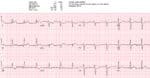 Lateral STEMI or Occlusion MI? | ECG cases | Emergency Medicine Cases