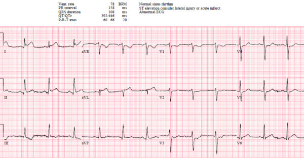 Lateral STEMI or Occlusion MI? | ECG cases | Emergency Medicine Cases