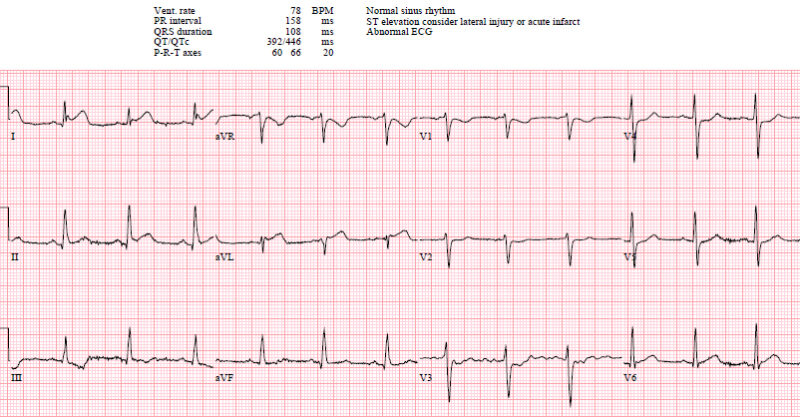 Lateral STEMI or Occlusion MI? | ECG cases | Emergency Medicine Cases