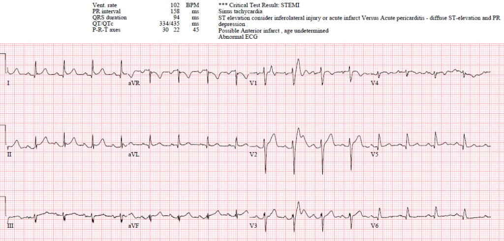 Lateral STEMI or Occlusion MI? | ECG cases | Emergency Medicine Cases