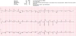 Lateral STEMI or Occlusion MI? | ECG cases | Emergency Medicine Cases