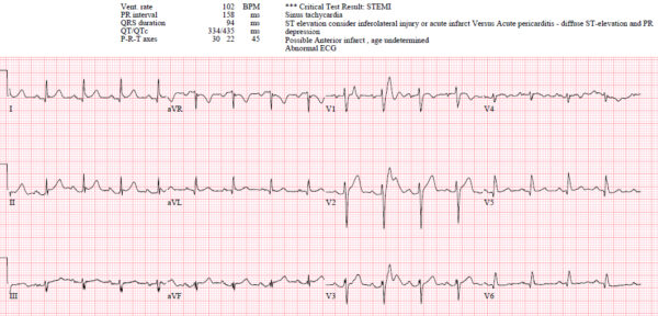 Lateral STEMI or Occlusion MI? | ECG cases | Emergency Medicine Cases