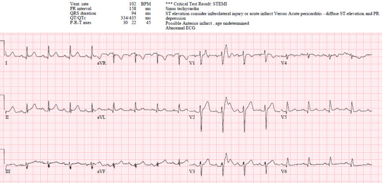 Lateral STEMI or Occlusion MI? | ECG cases | Emergency Medicine Cases